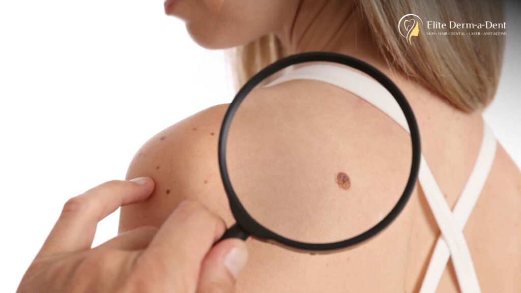 Skin Tag And DPN Removal In Thane (2025) | Dr. Arefa Patel | Elite ...